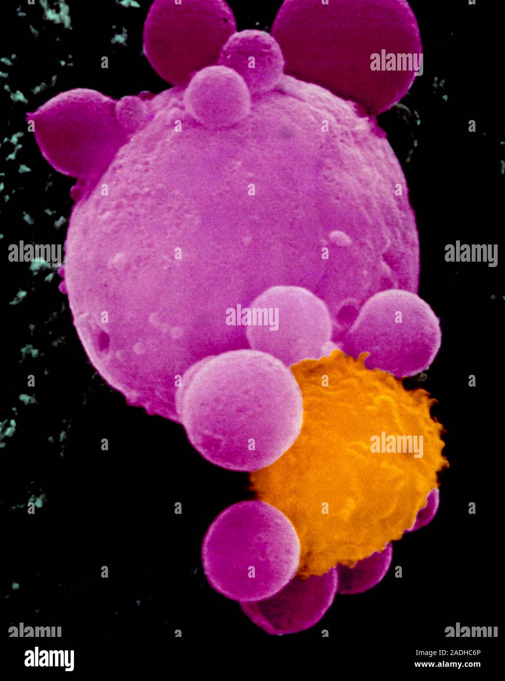 Cancer cell death. Coloured Scanning Electron Micrograph (SEM) showing ...