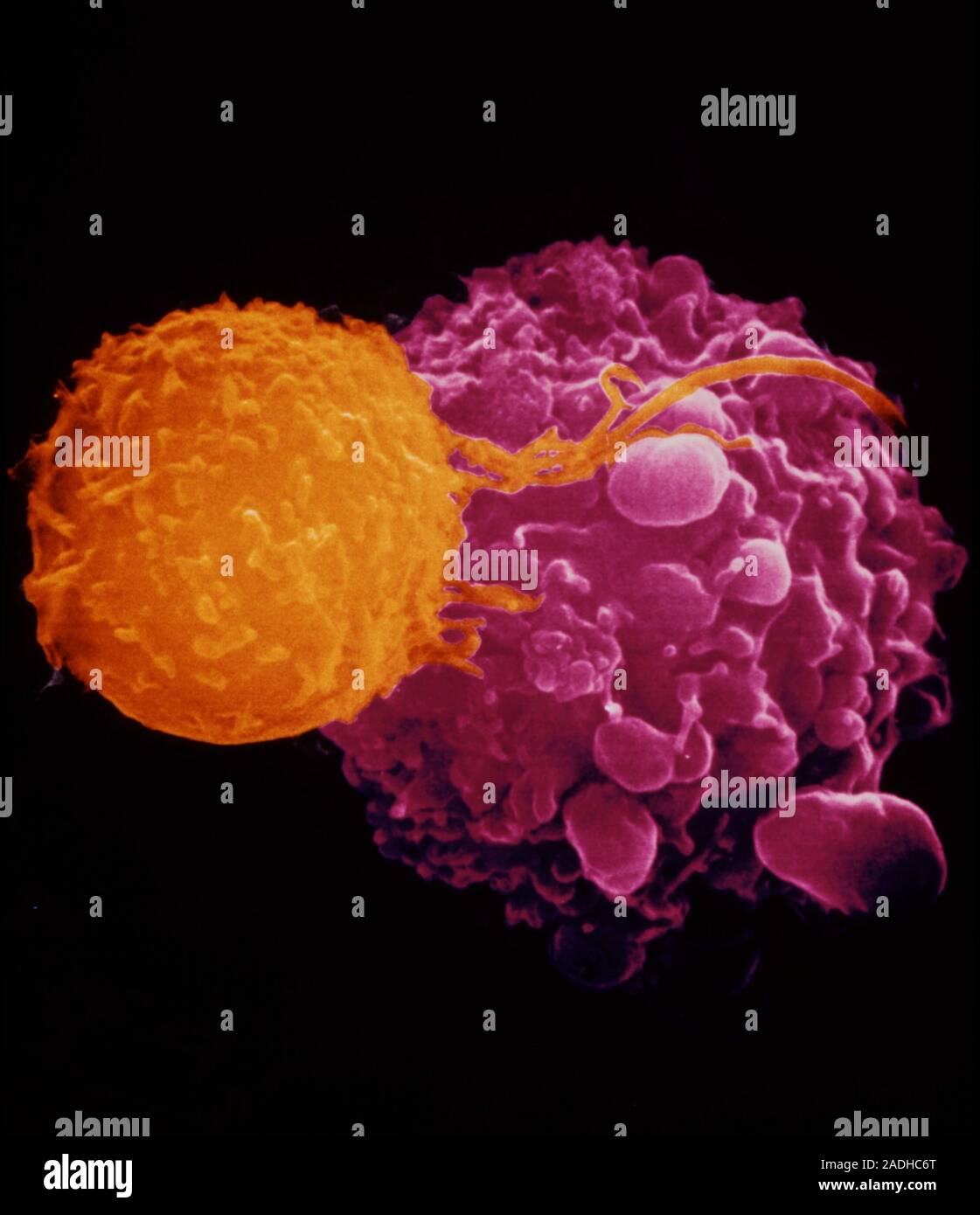 Cancer cell death. Coloured Scanning Electron Micrograph (SEM) showing ...