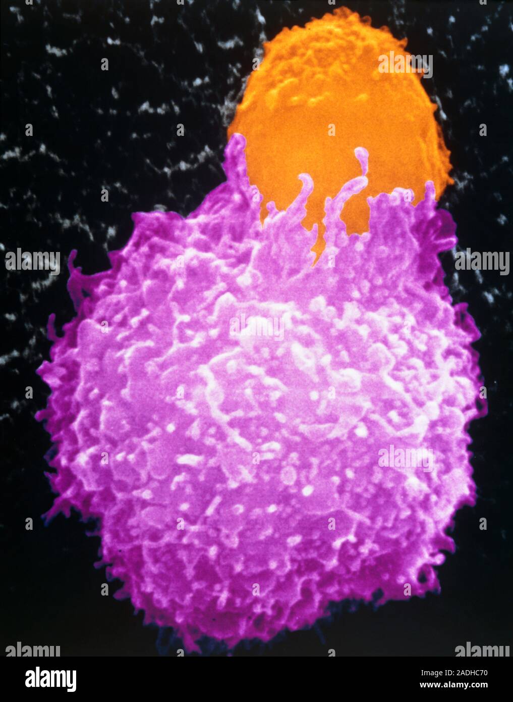 Cancer cell death. Coloured Scanning Electron Micrograph (SEM) of a ...