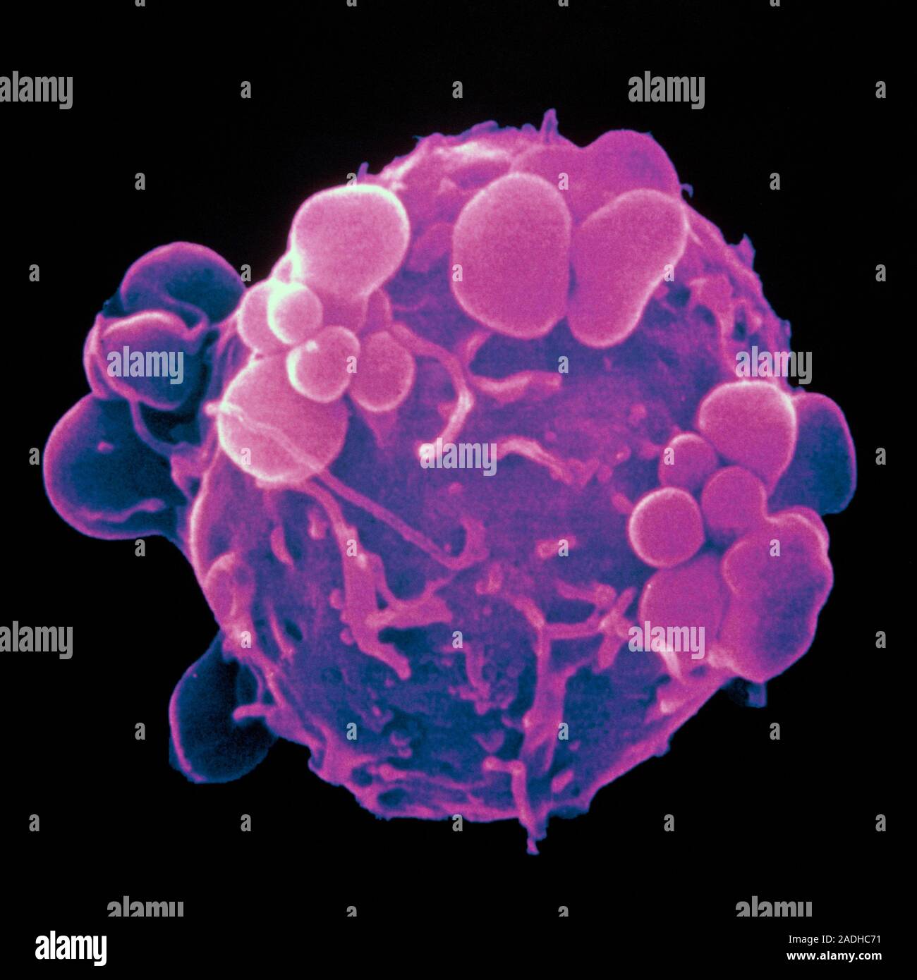 Cancer cell apoptosis. Coloured Scanning Electron Micrograph (SEM ...