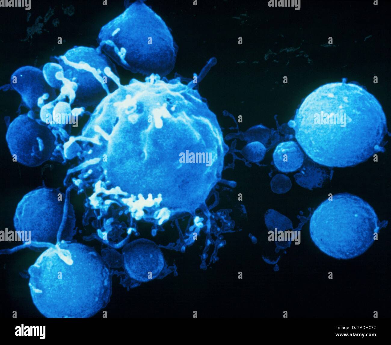 Cancer cell apoptosis. Coloured Scanning Electron Micrograph (SEM ...