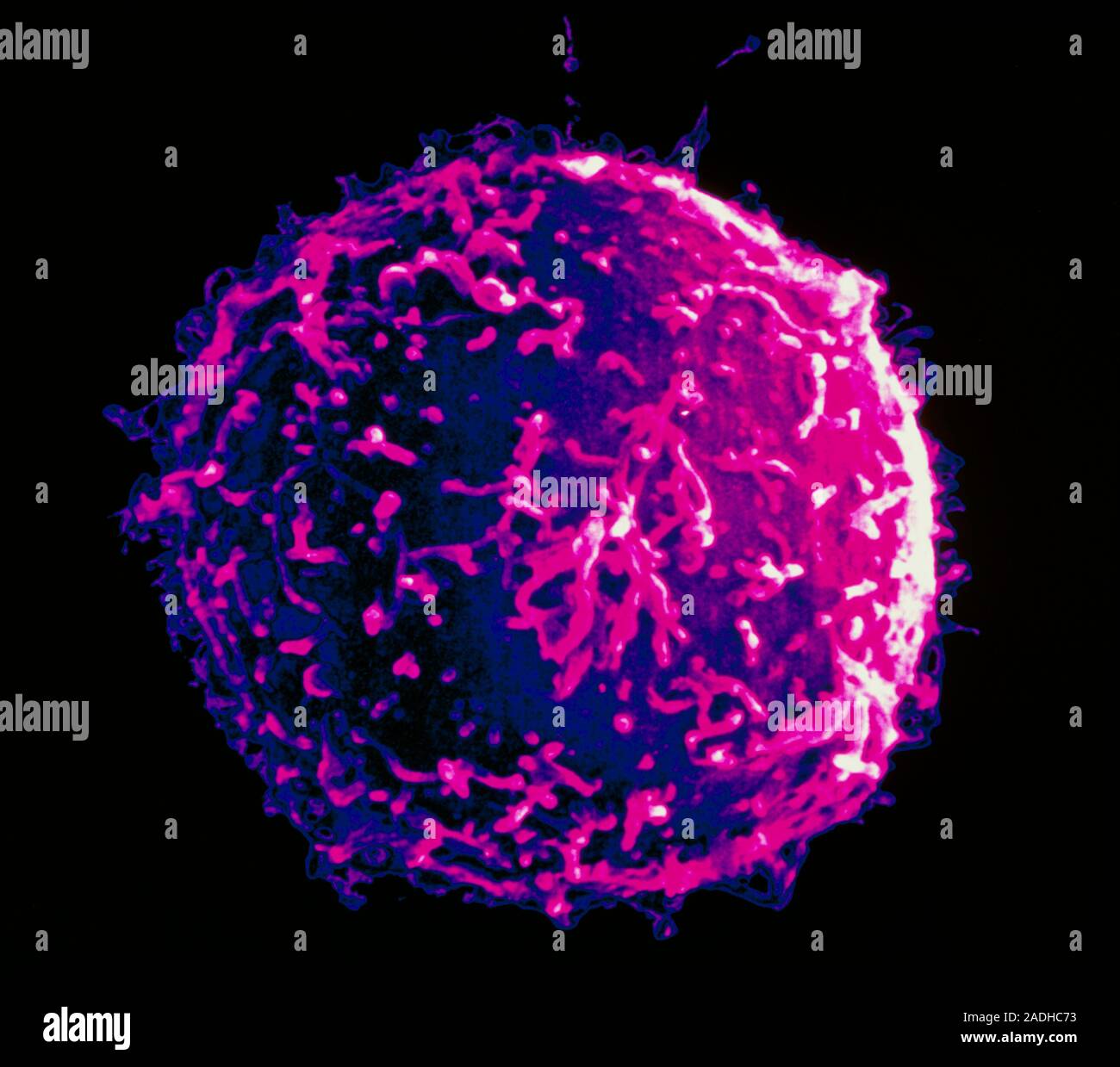 Leukaemia cell. Coloured scanning electron micrograph (SEM) of a ...