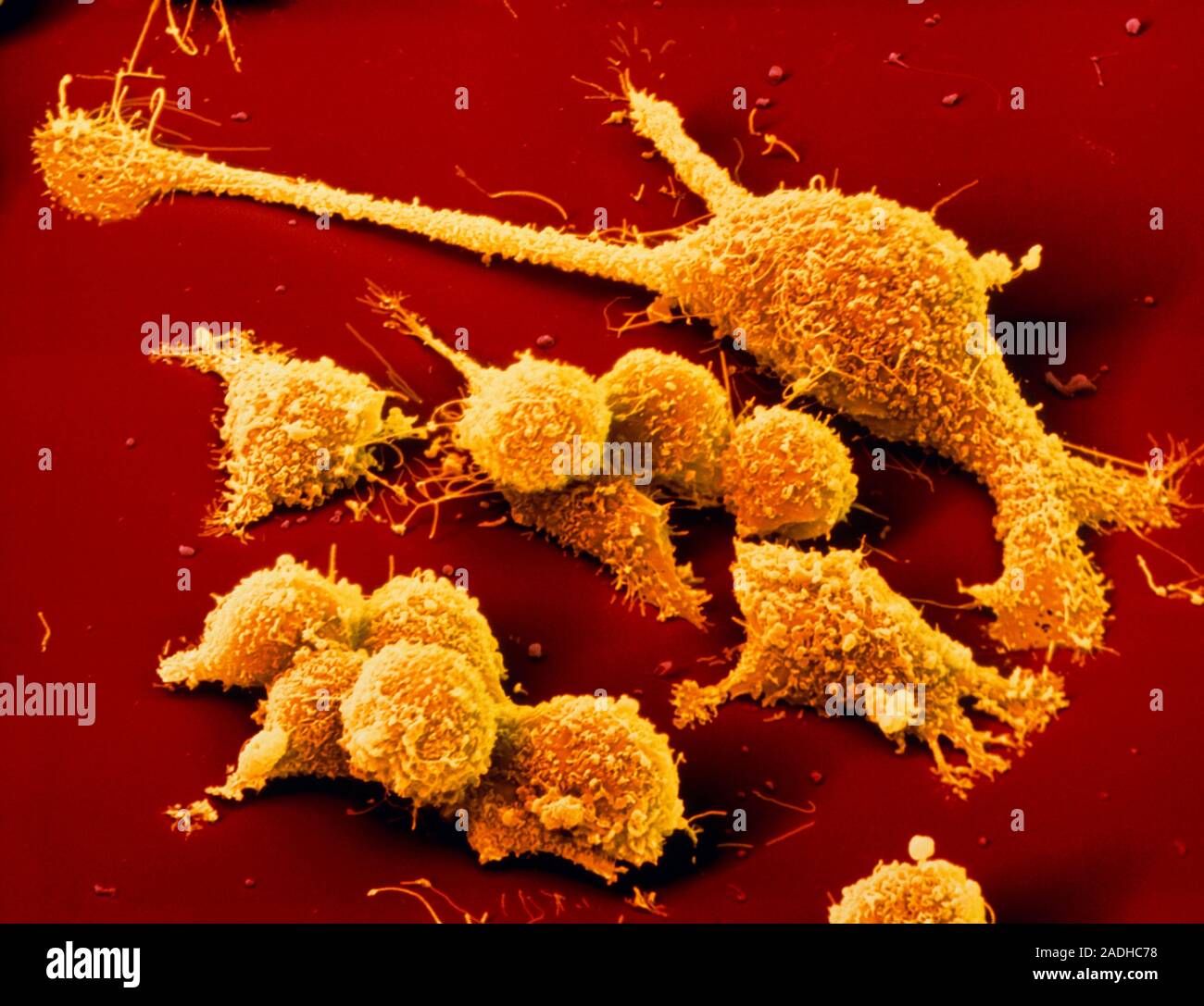 Colon cancer. Coloured Scanning Electron Micro- graph (SEM) of cells ...