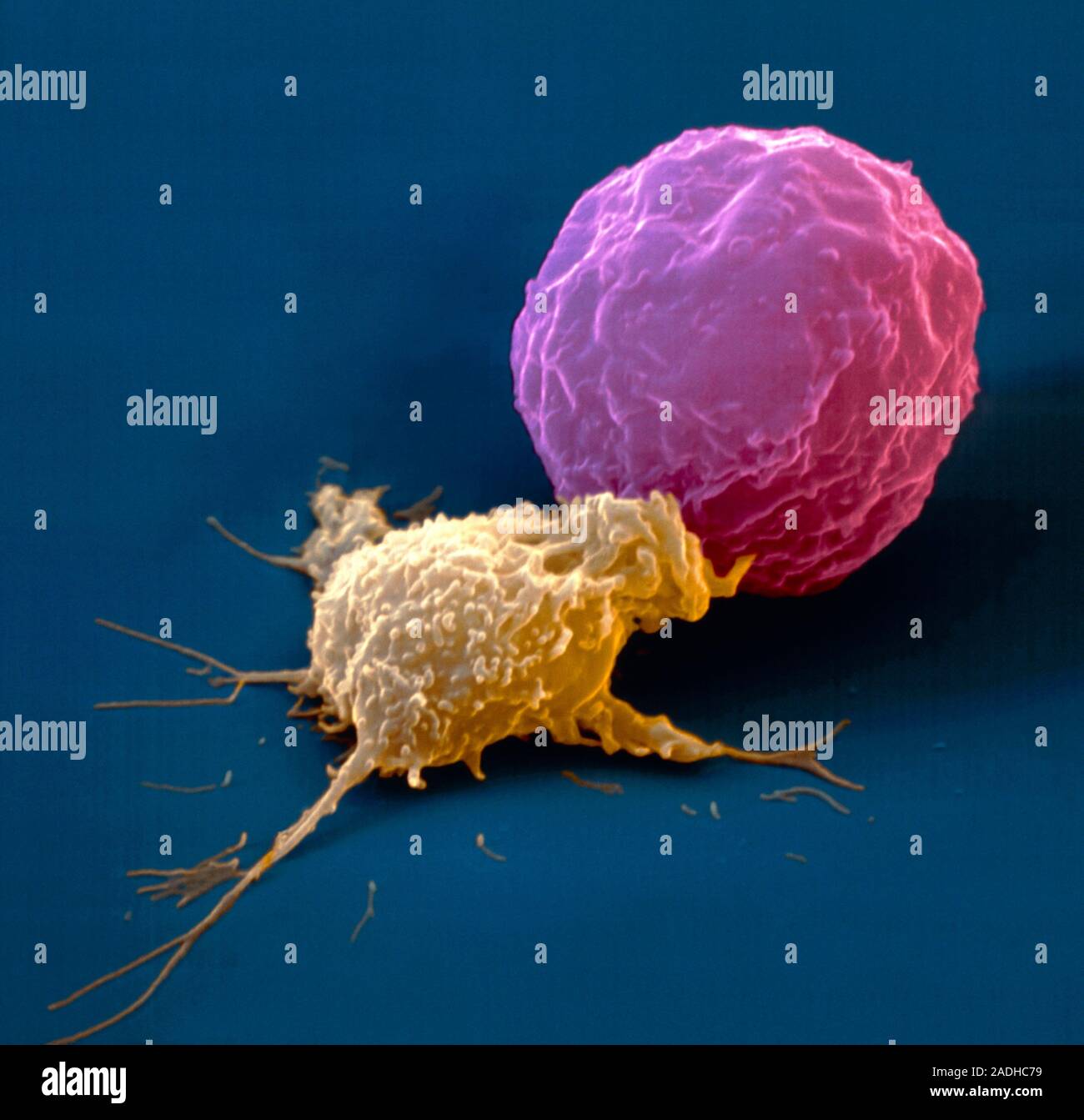 Cancer attacked by killer cell. Scanning Electron Micrograph (SEM) of a ...