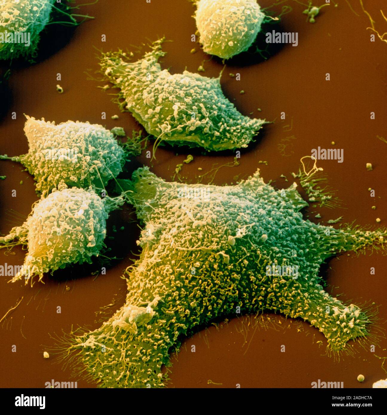 Colon cancer. Coloured Scanning Electron Micro- graph (SEM) of cells ...
