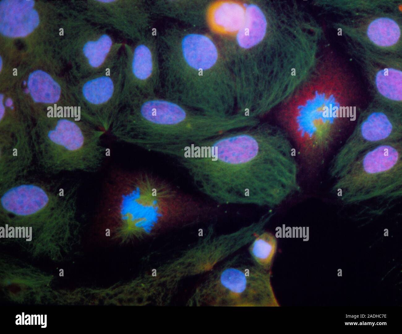 Colon cancer. Immunofluorescent light micrograph of human colon cancer ...