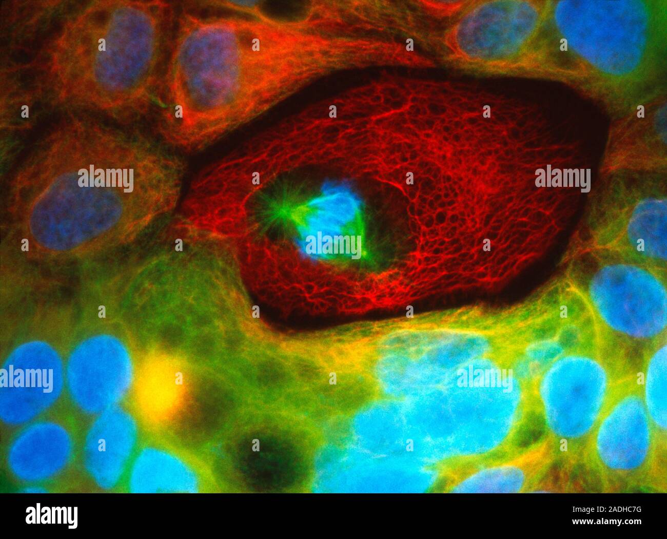 Colon cancer. Immunofluorescent light micrograph of human colon cancer ...