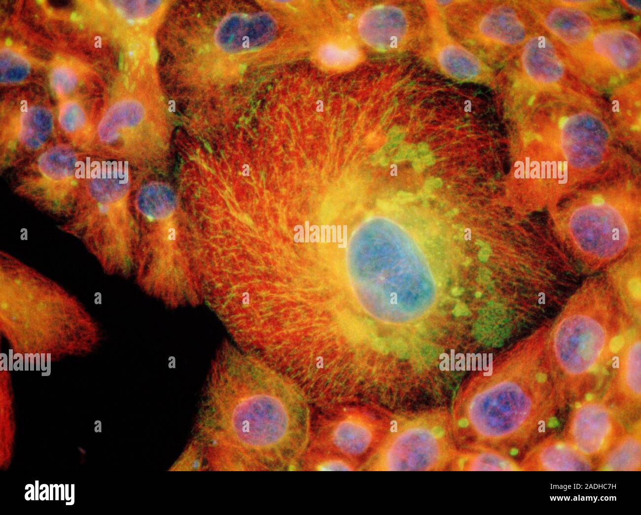 Drug-resistant cancer cells. Immunofluorescent light micrograph of ...