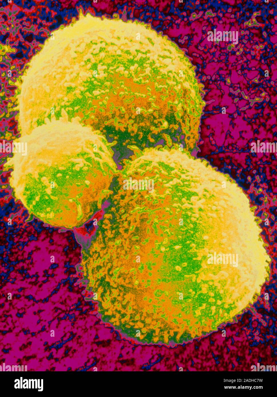 Cancer cell death. Coloured scanning electron micrograph (SEM) of a T ...