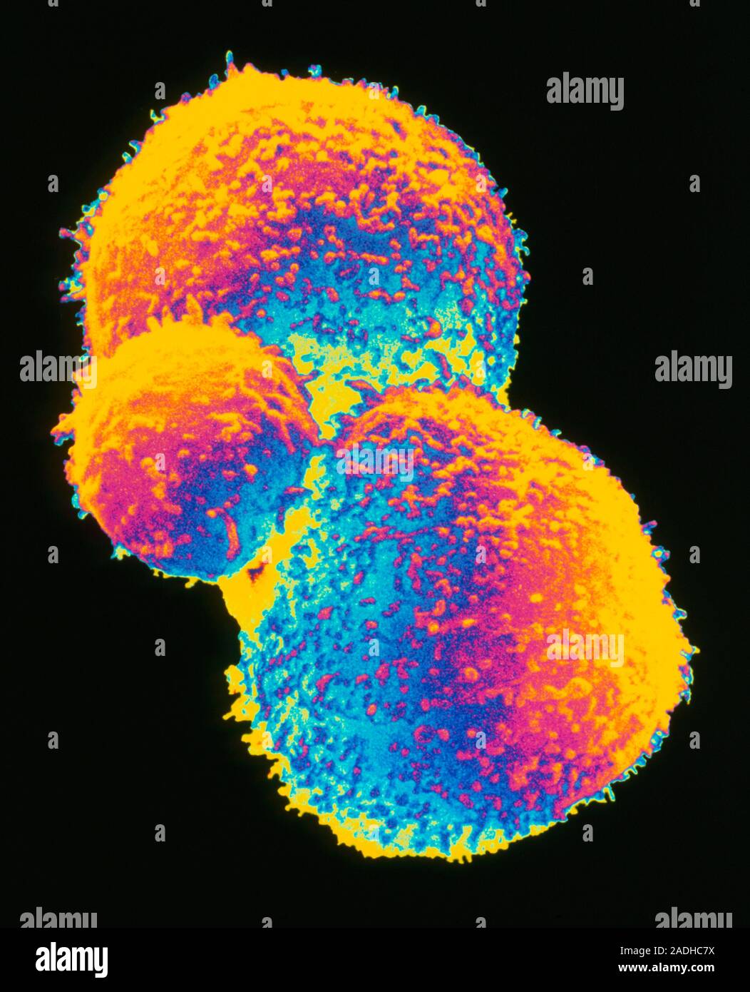 Cancer cell death. Coloured scanning electron micrograph (SEM) of a T ...