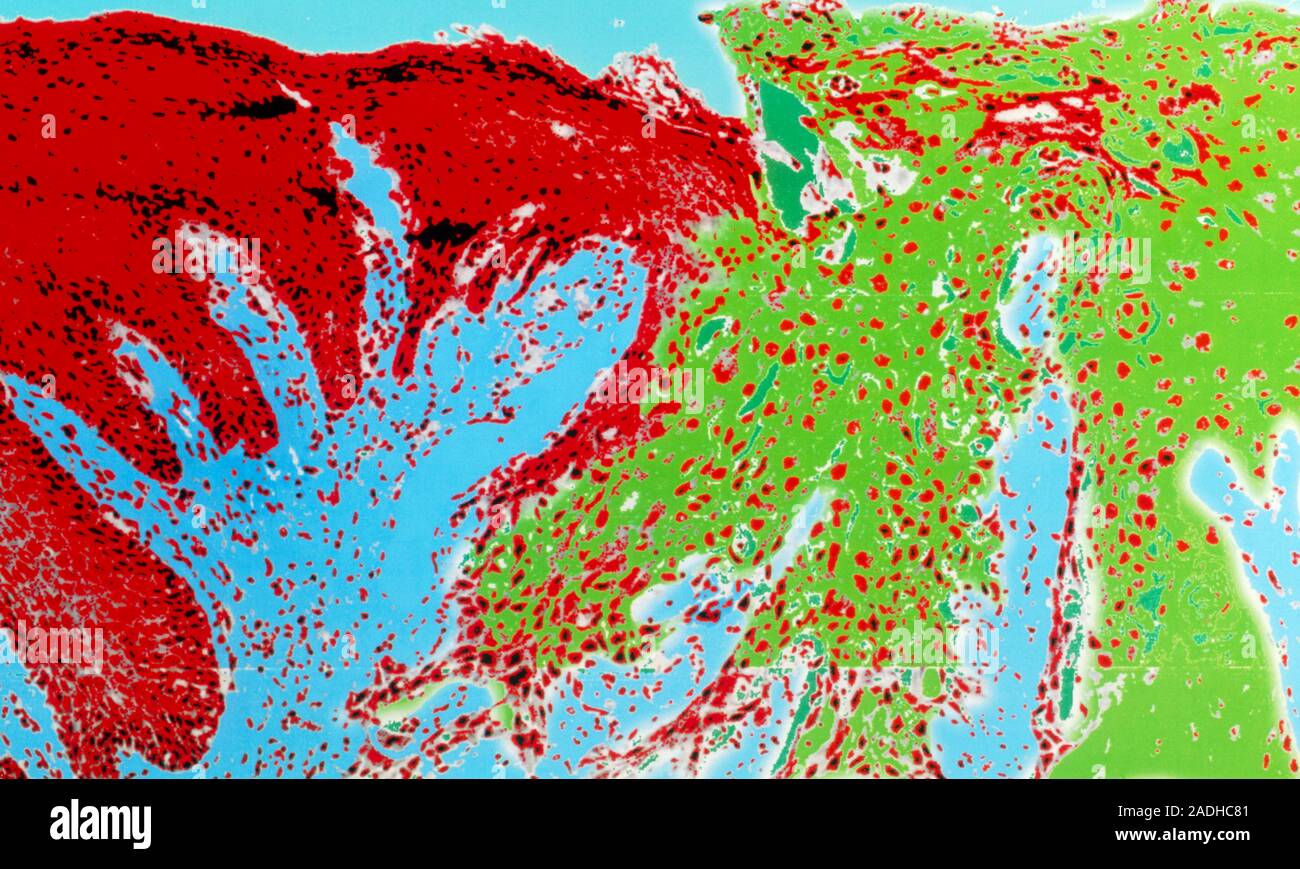 Rodent ulcer. Coloured light micrograph of a section through human skin ...