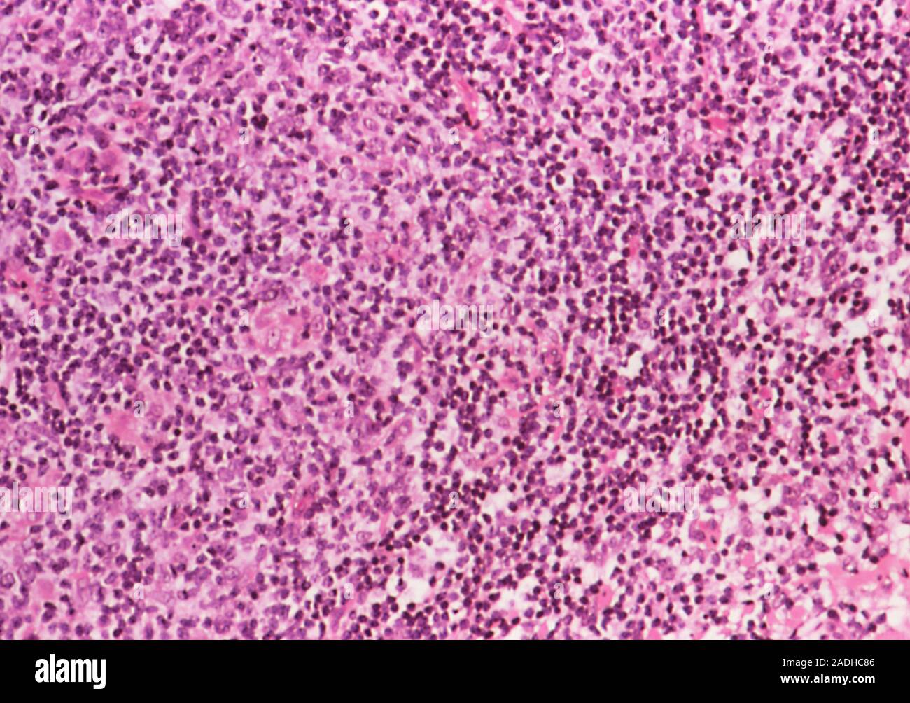Low grade non-Hodgkin's lymphoma. Coloured light micrograph (LM) of a ...