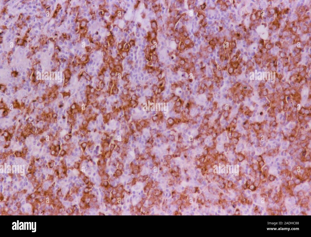High grade non-Hodgkin's lymphoma. Coloured light micrograph (LM) of a ...