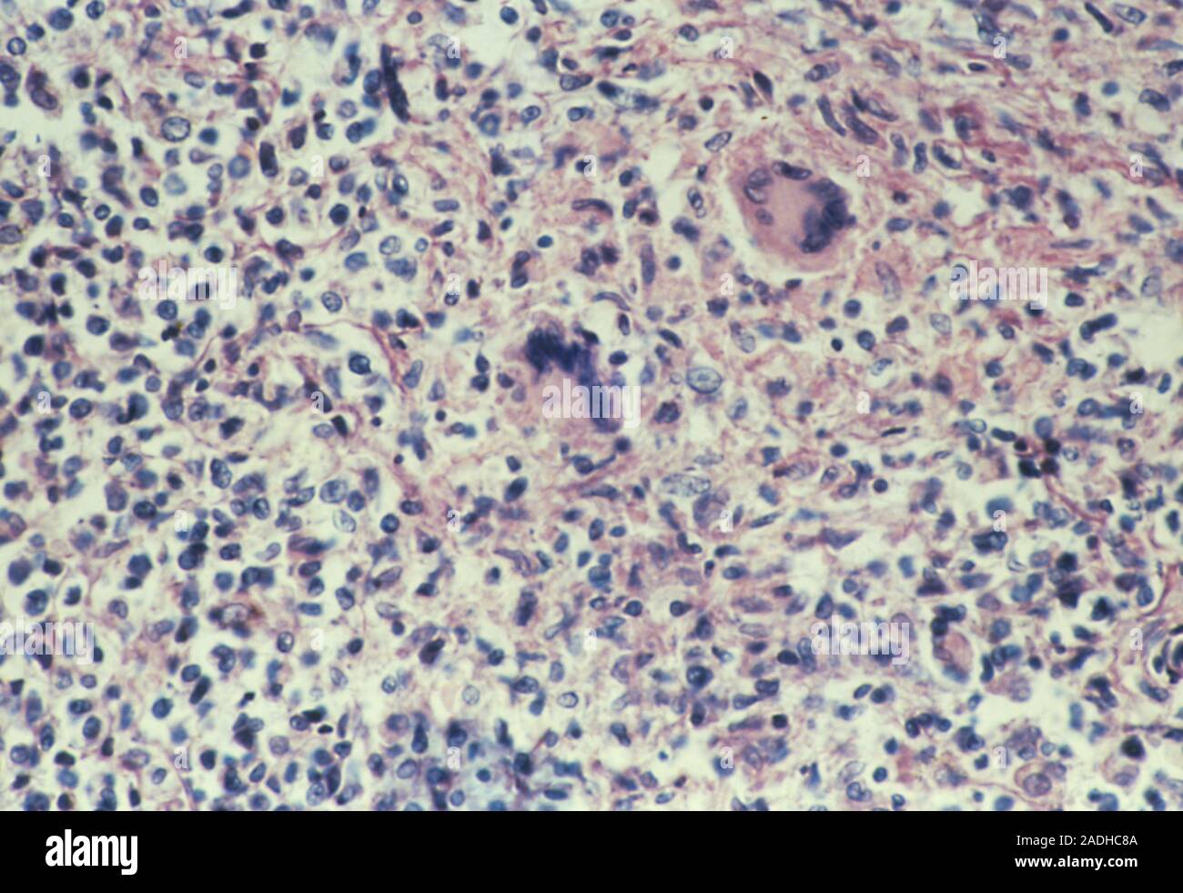 High grade non-Hodgkin's lymphoma. Light micrograph of a section ...