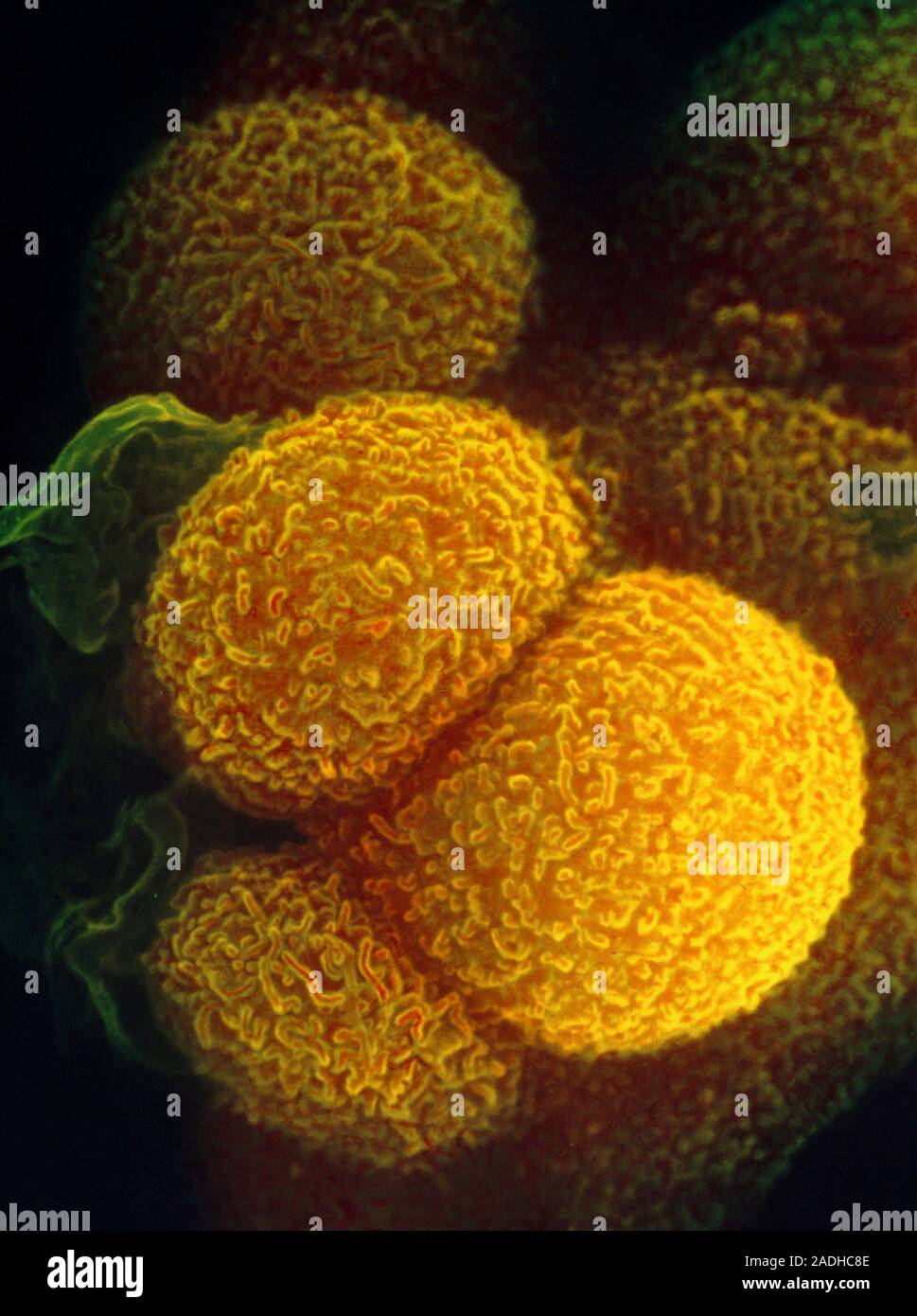 Colon cancer. Coloured scanning electron micro- graph (SEM) of ...