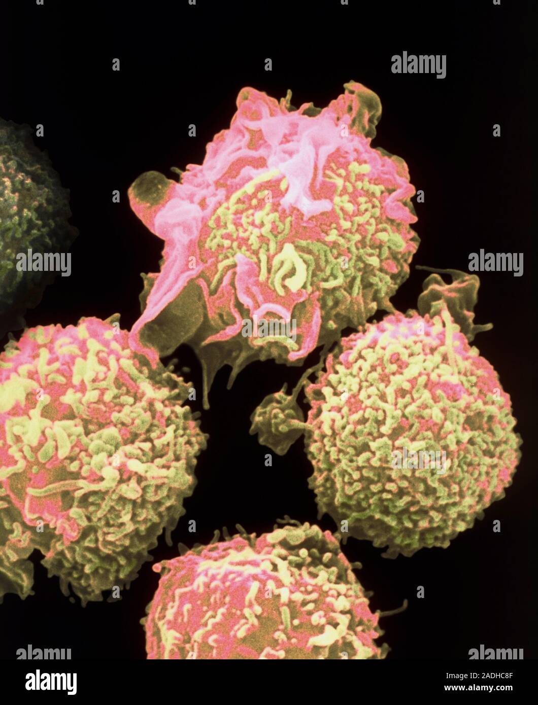 Hairy cell leukaemia. Coloured scanning electron micrograph (SEM) of ...