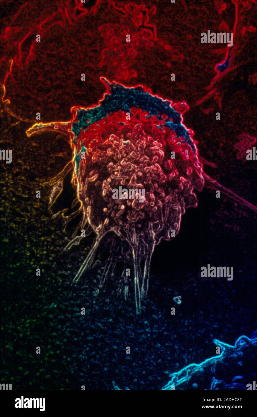 Lung cancer cell. Coloured scanning electron micrograph (SEM) of an ...