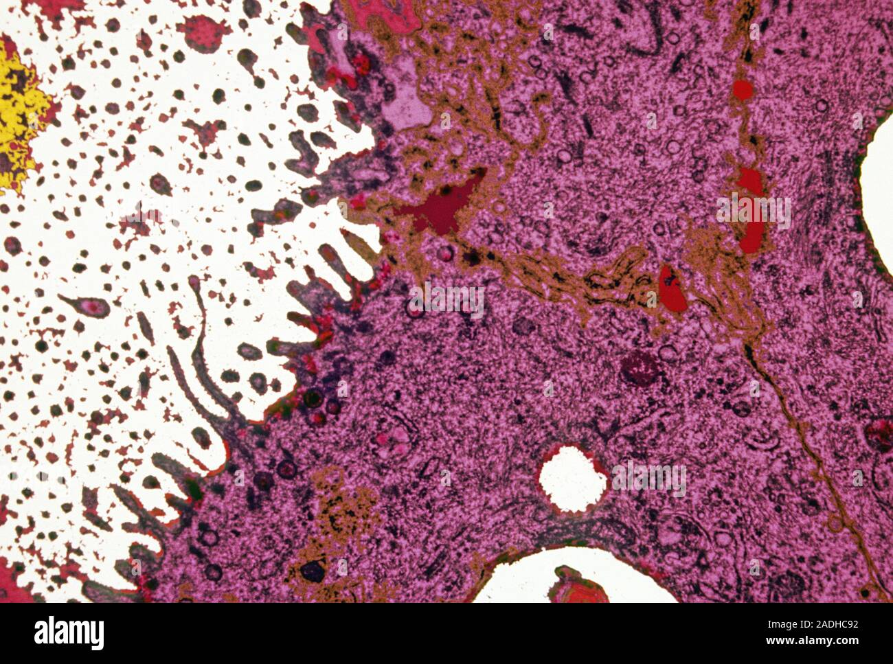 Intestinal tract cancer cells. Coloured trans- mission electron ...