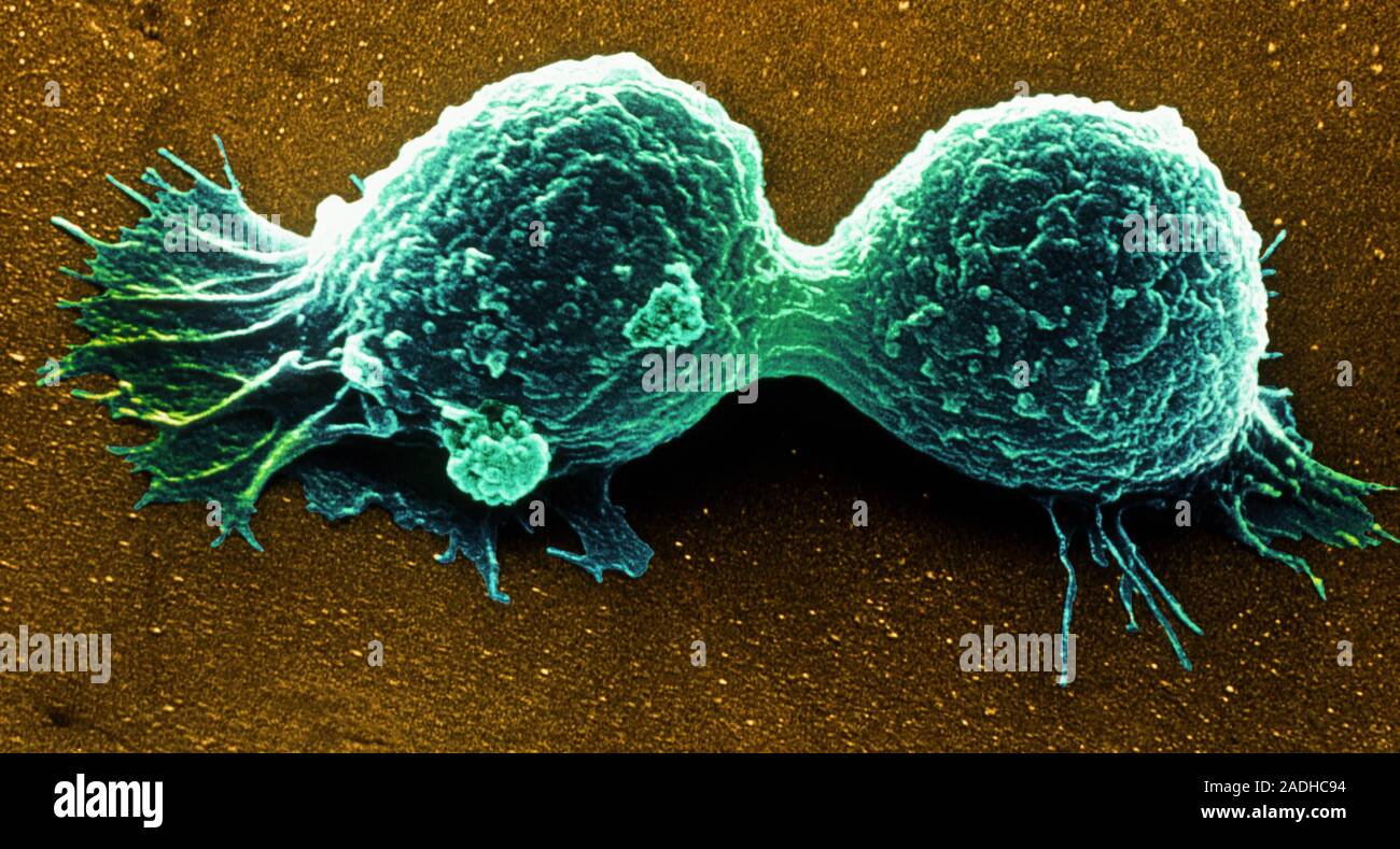 Cancer cell division. Coloured scanning electron micrograph (SEM) of ...