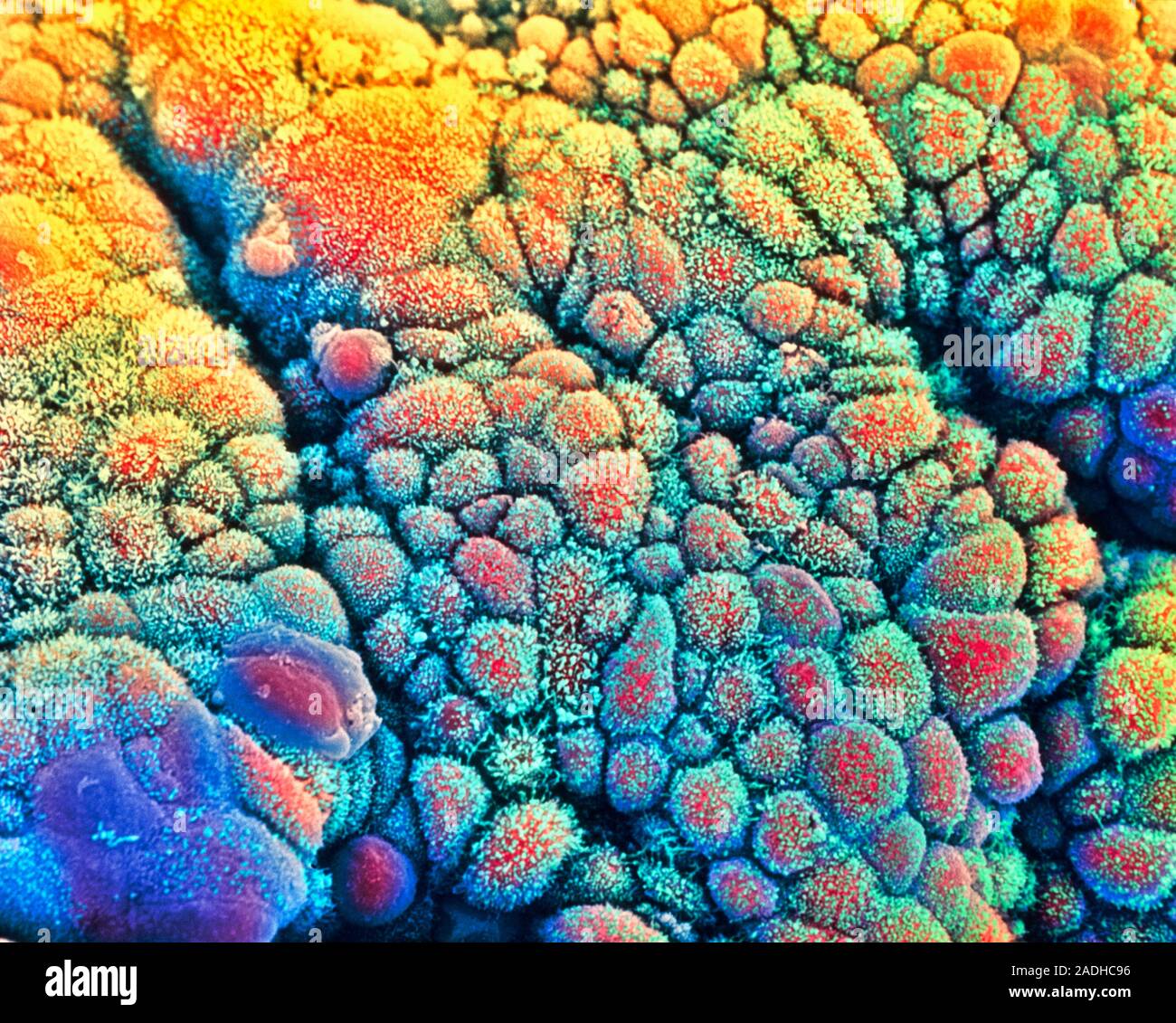 Intestinal cancer. Coloured scanning electron micrograph (SEM) of ...