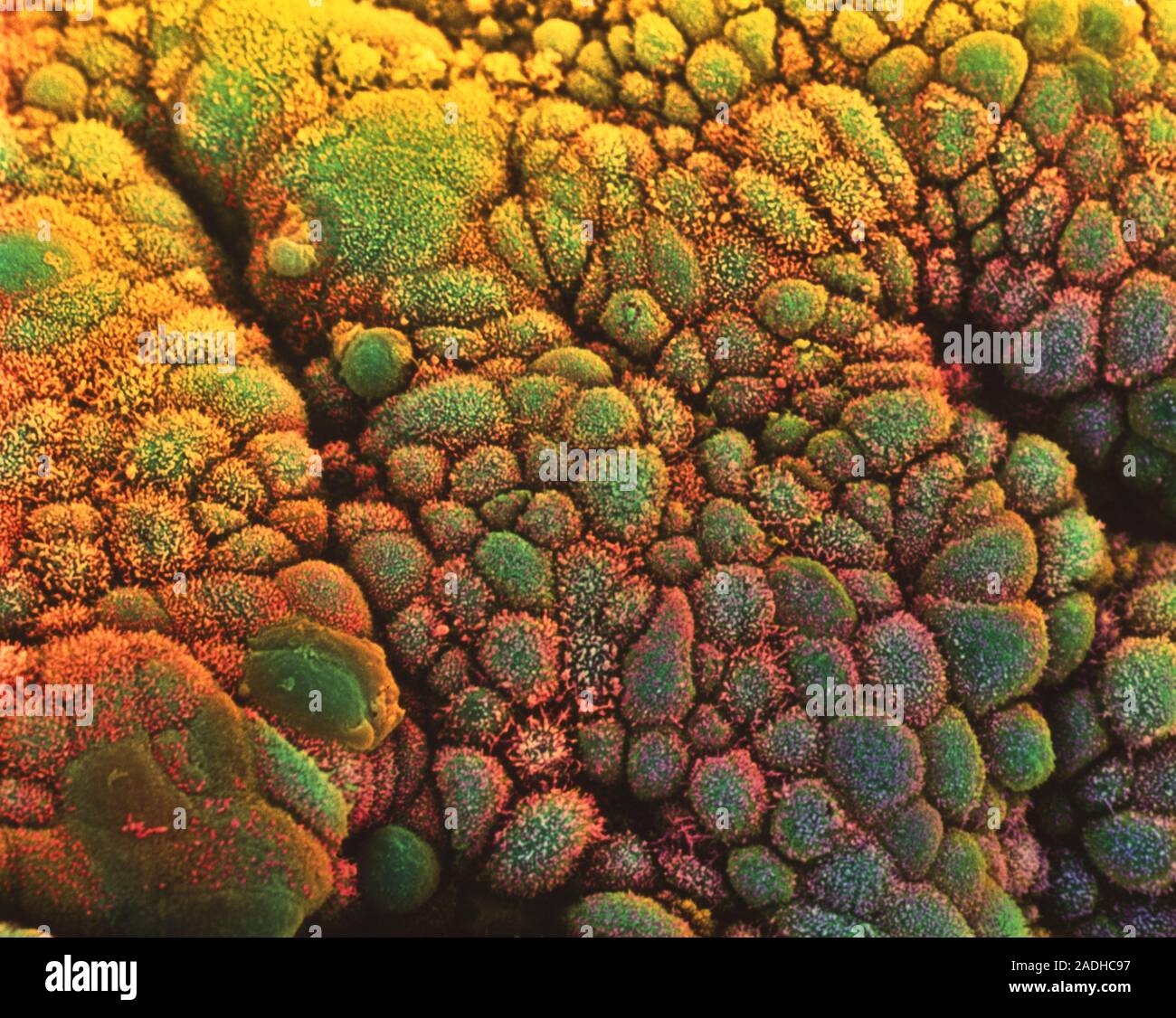 Intestinal cancer. Coloured scanning electron micrograph (SEM) of ...