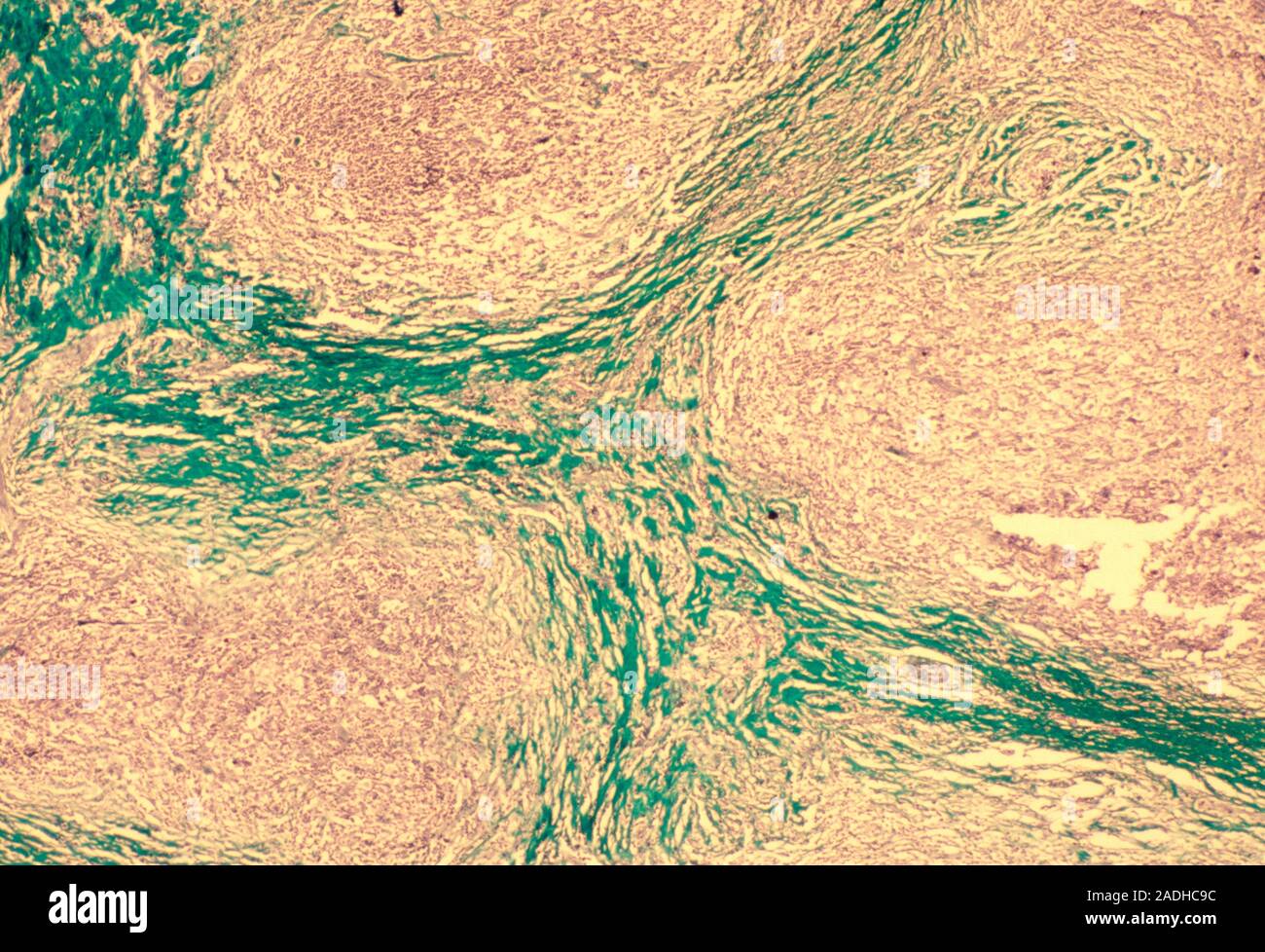 Hodgkin's disease. Light micrograph of a section through a lymph node ...