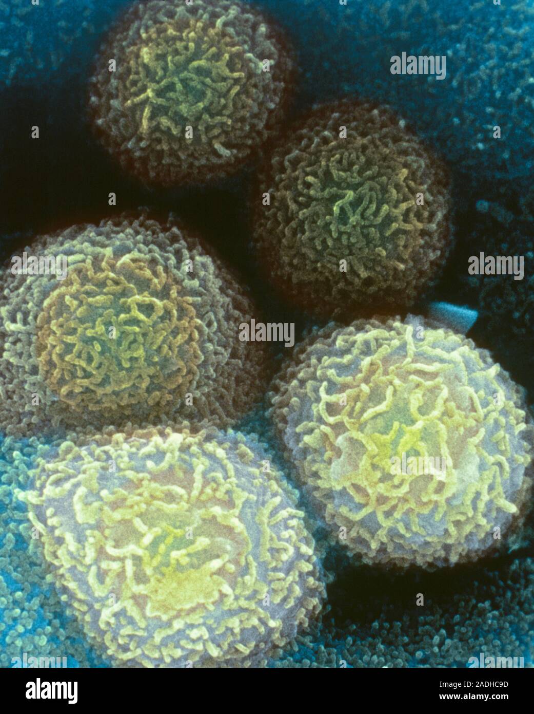 Colon cancer. Coloured scanning electron micrograph (SEM) of carcinoma ...