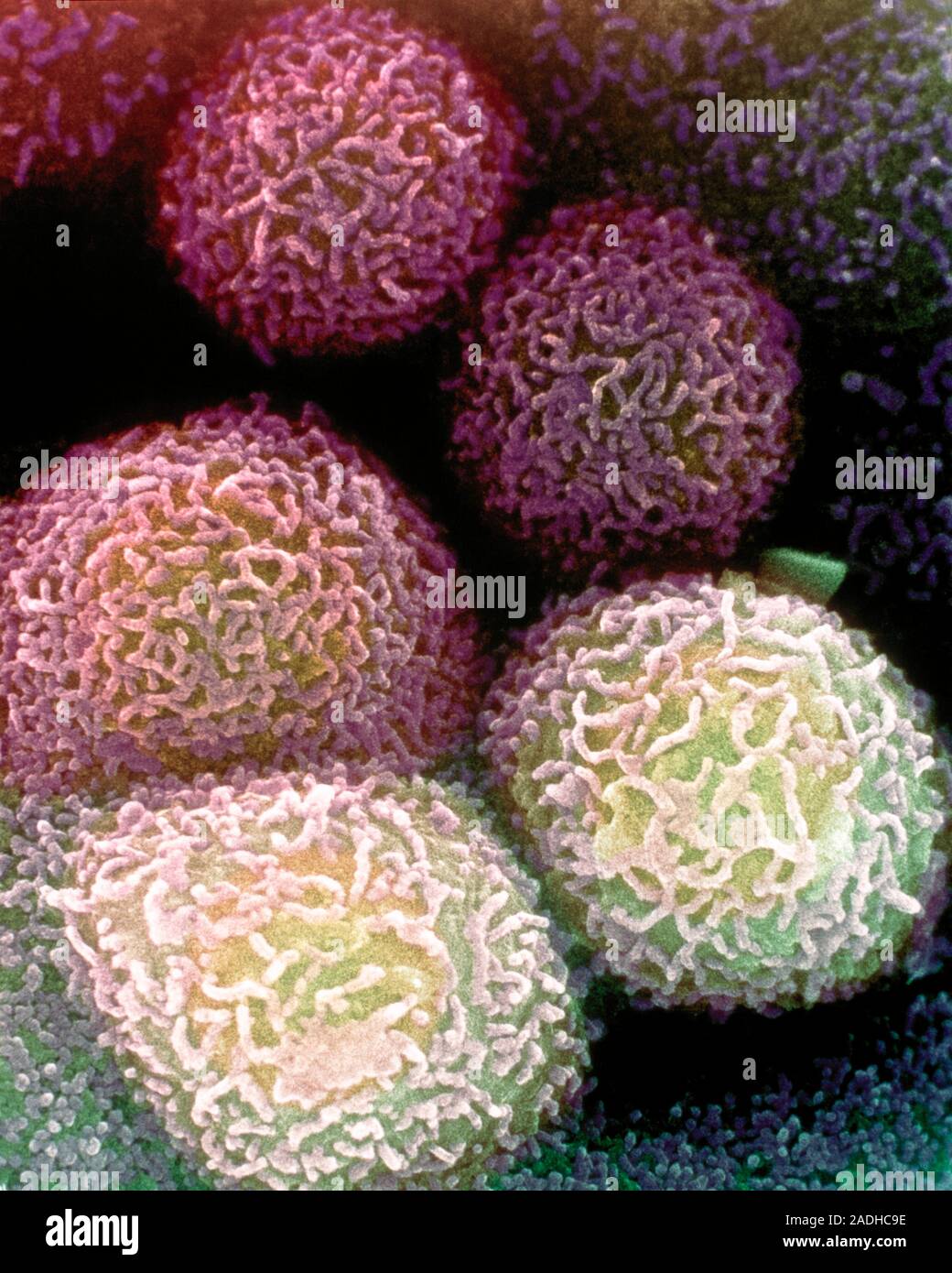 Colon cancer. Coloured scanning electron micro- graph (SEM) of ...