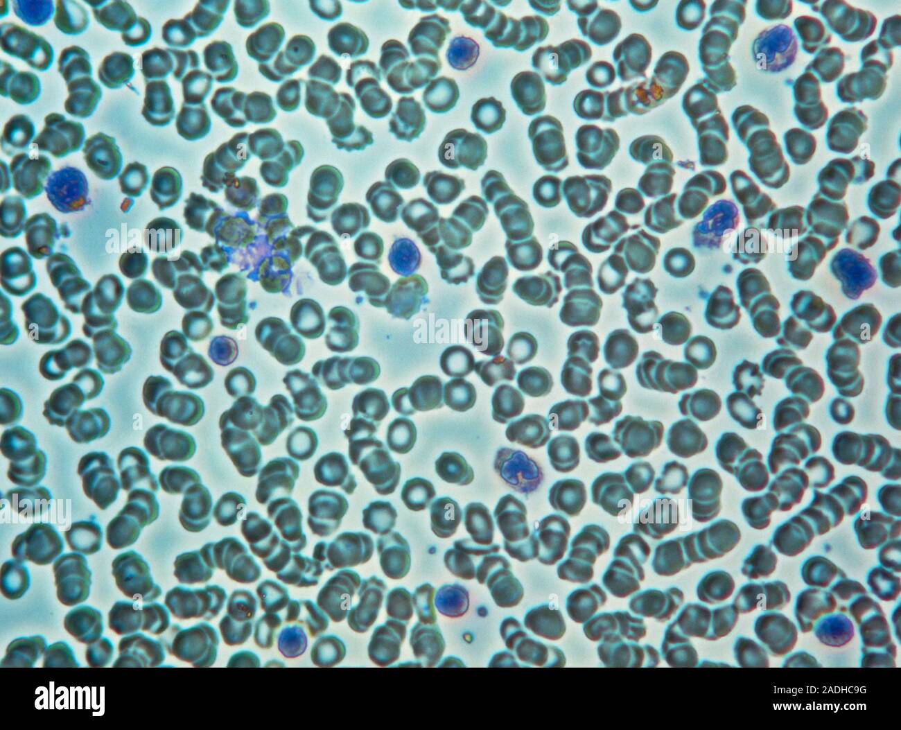 Leukaemia blood cells. Light micrograph of blood showing numerous white ...