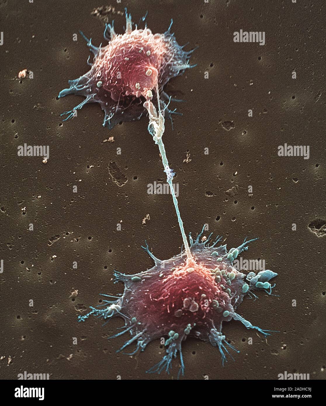 Prostate cancer cell division. Coloured scanning electron micrograph ...