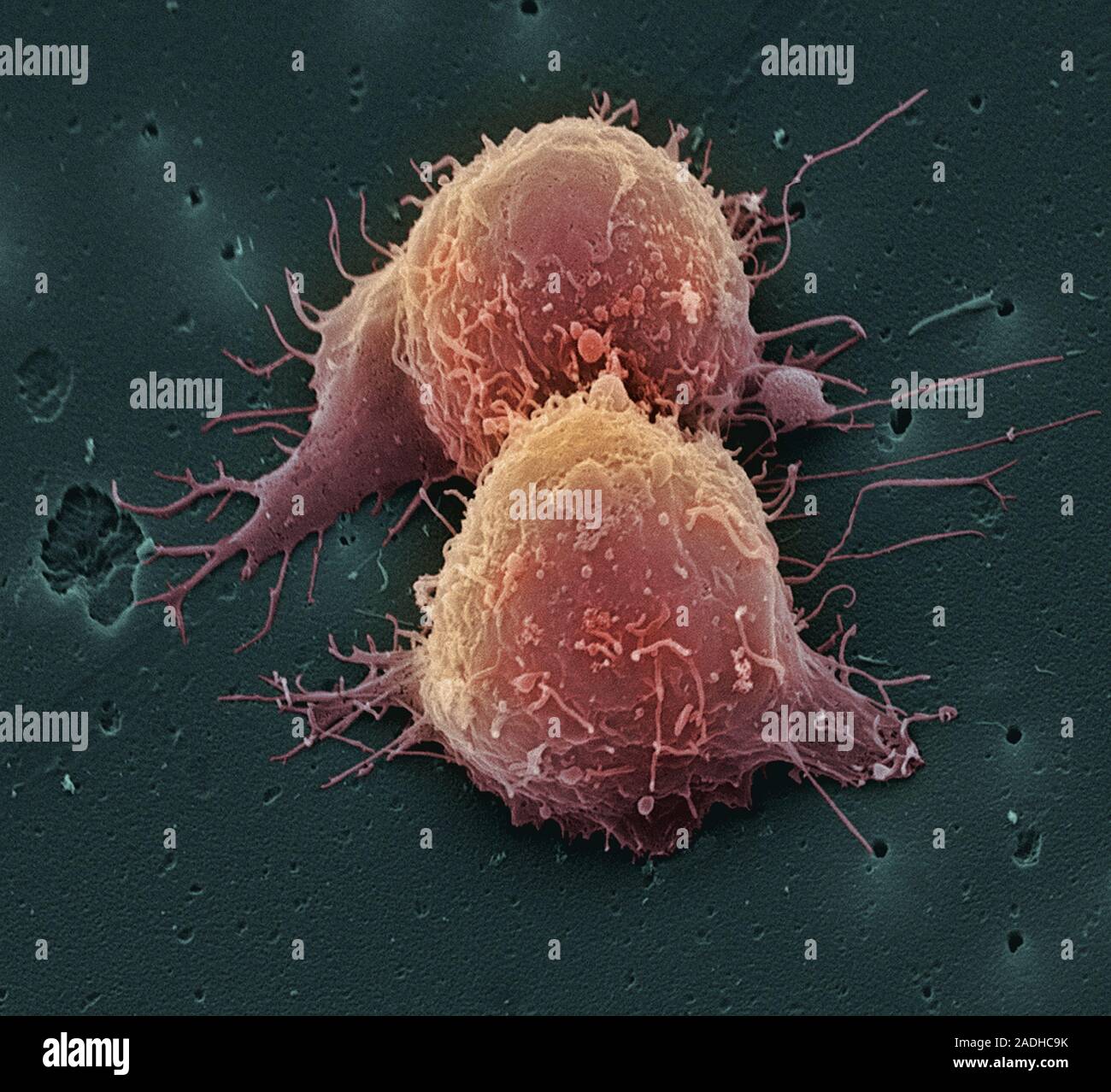 Lung cancer cell division. Coloured scanning electron micrograph (SEM ...