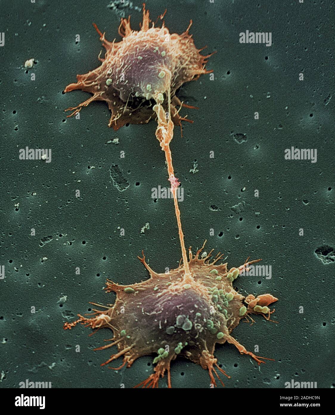 Prostate cancer cell division. Coloured scanning electron micrograph ...