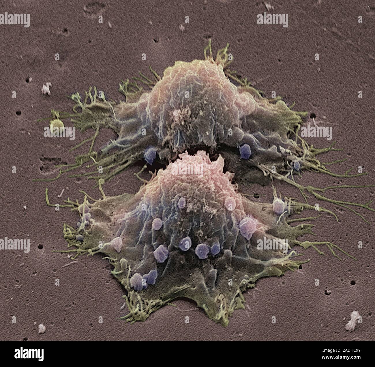 Cancer cell division. Coloured scanning electron micrograph (SEM) of ...
