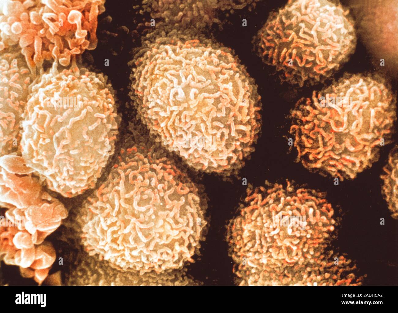 Colon cancer cells. Coloured scanning electron micrograph (SEM) of ...