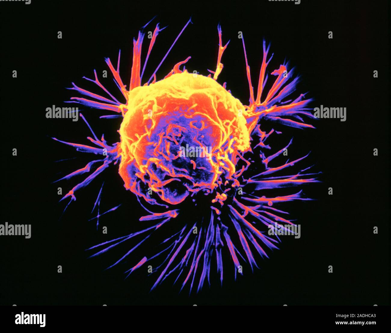 Cancer cell. Coloured scanning electron micrograph (SEM) of a cancer ...