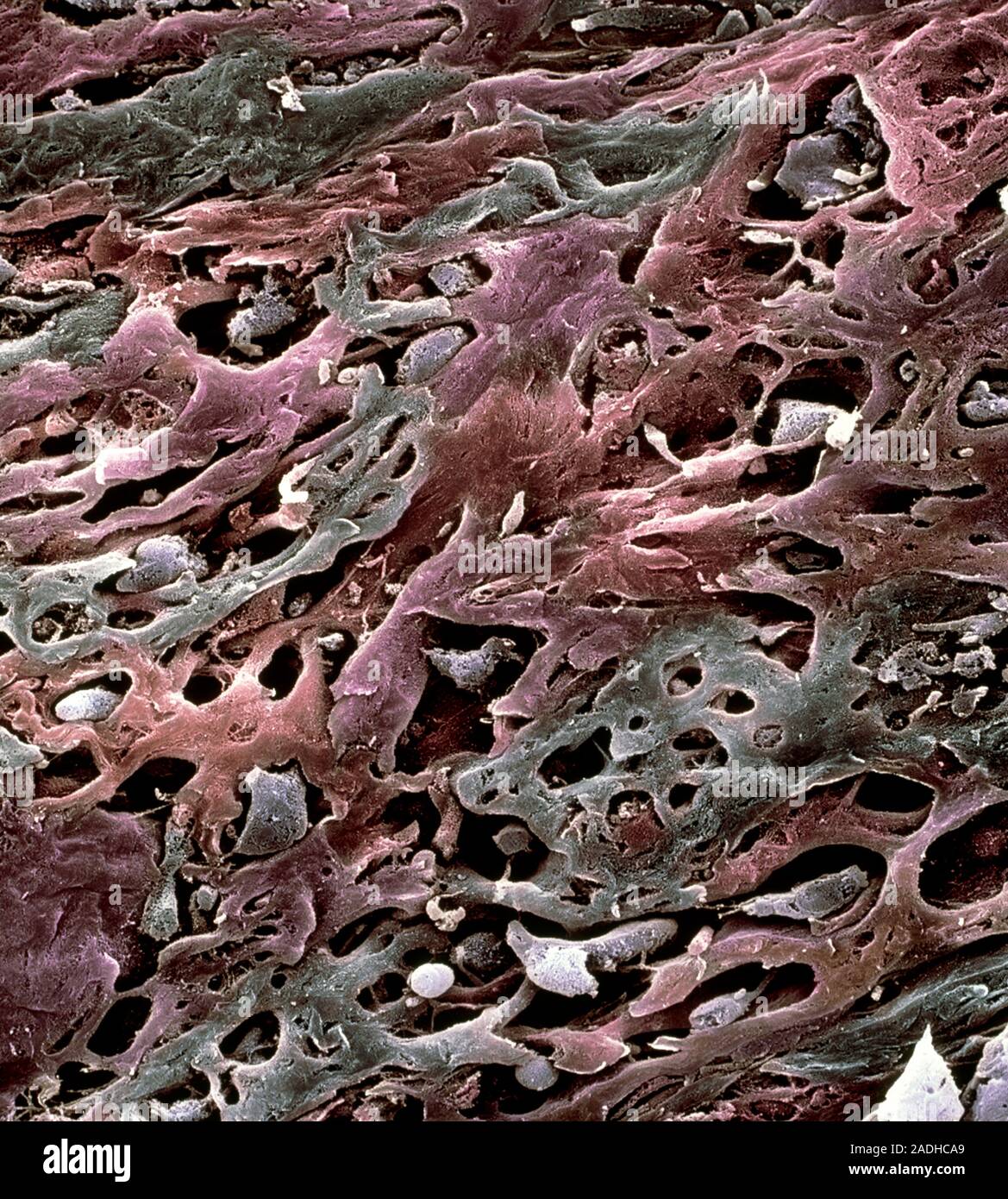 Lung cancer. Scanning electron micrograph (SEM) of a section through a ...