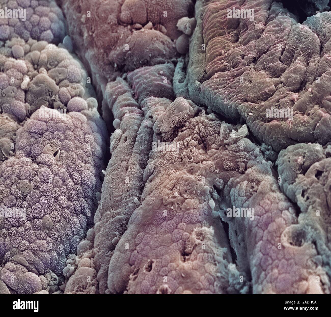 Colon cancer. Coloured scanning electron micrograph (SEM) of the mucosa ...