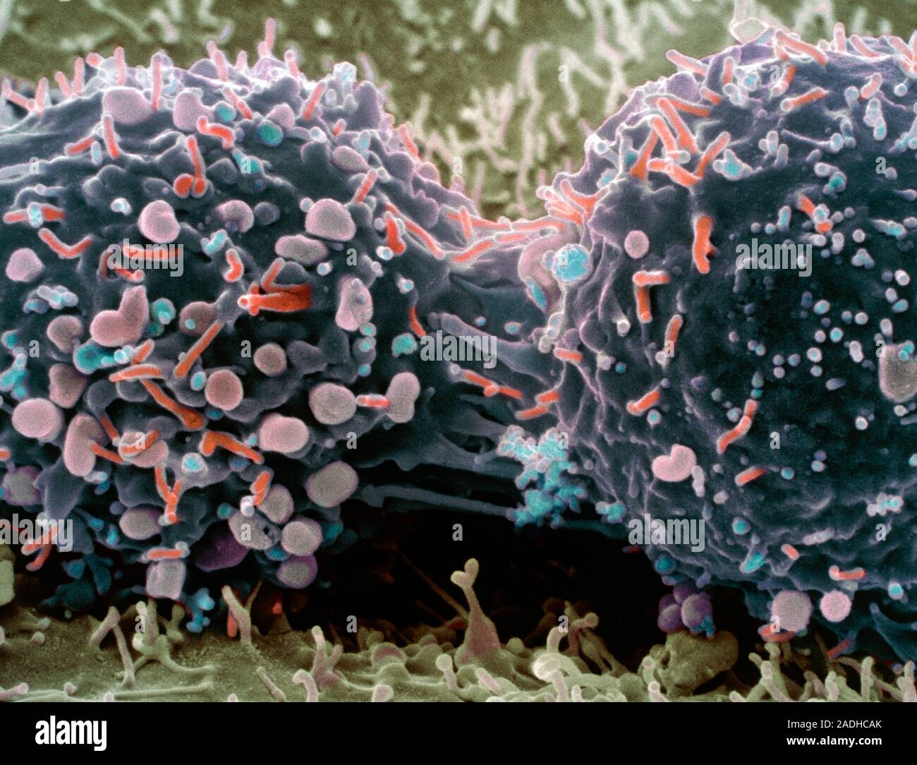 Cancer cell division. Coloured scanning electron micrograph (SEM) of a ...