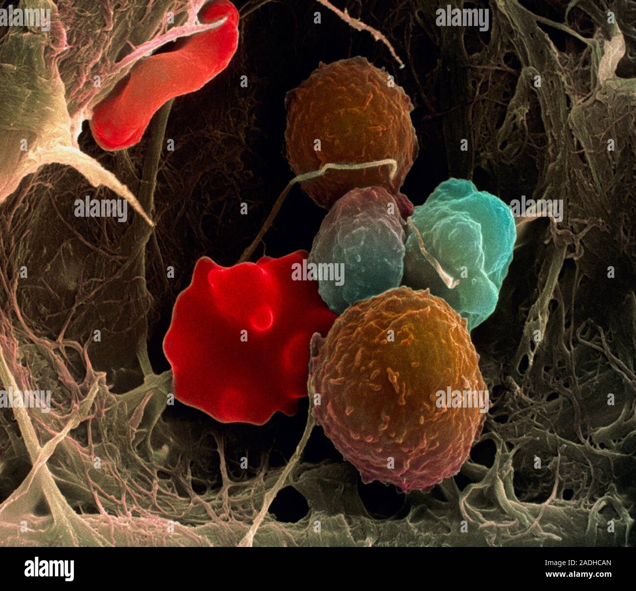 Leukaemia blood cells. Coloured scanning electron micrograph (SEM) of ...