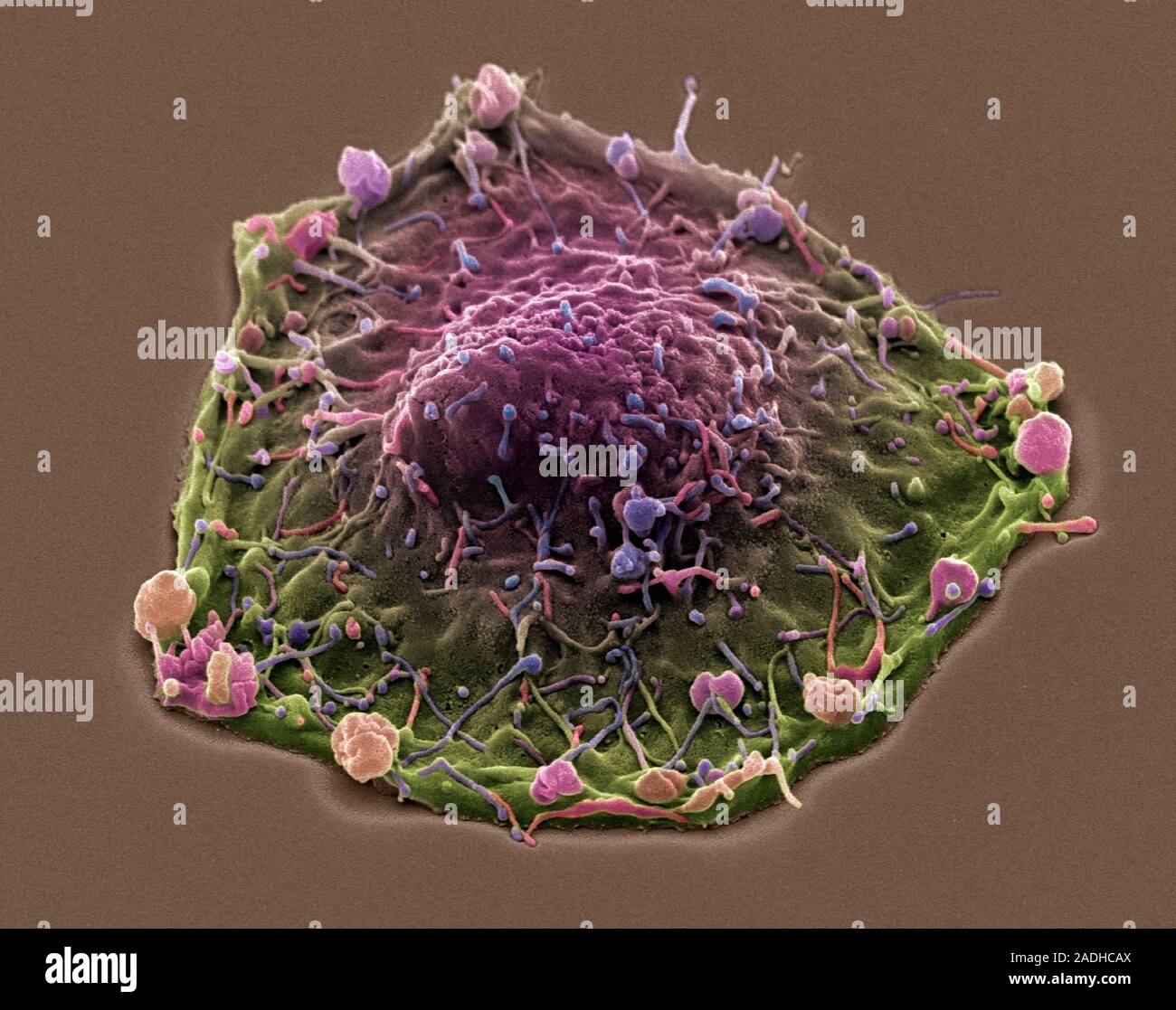 Colon cancer. Coloured scanning electron micrograph (SEM) of a cancer ...