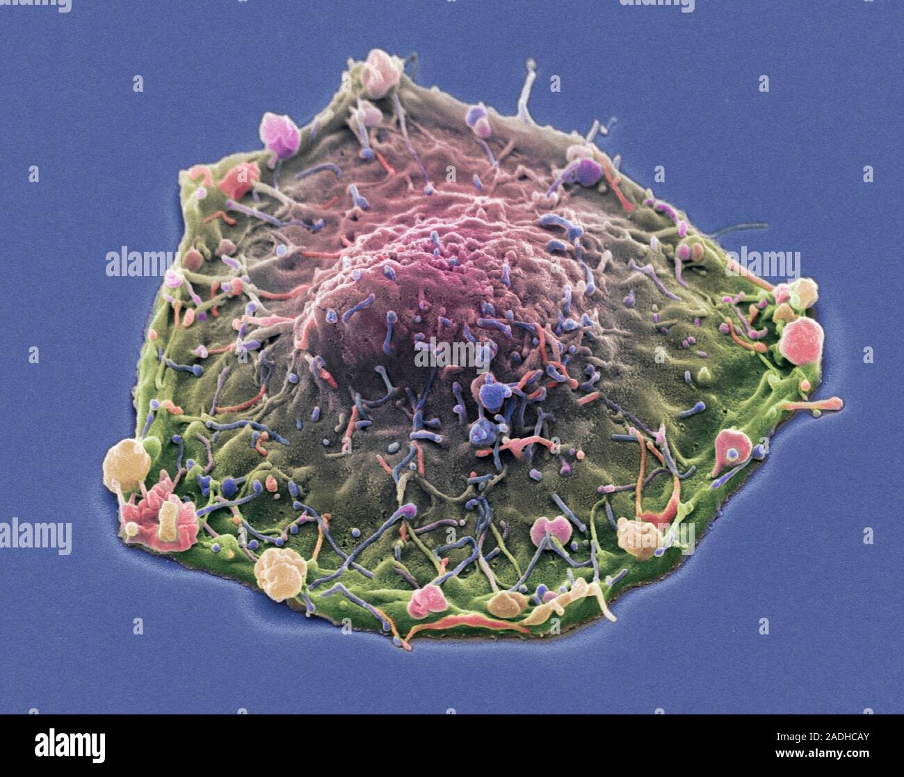 Colon cancer. Coloured scanning electron micrograph (SEM) of a cancer ...