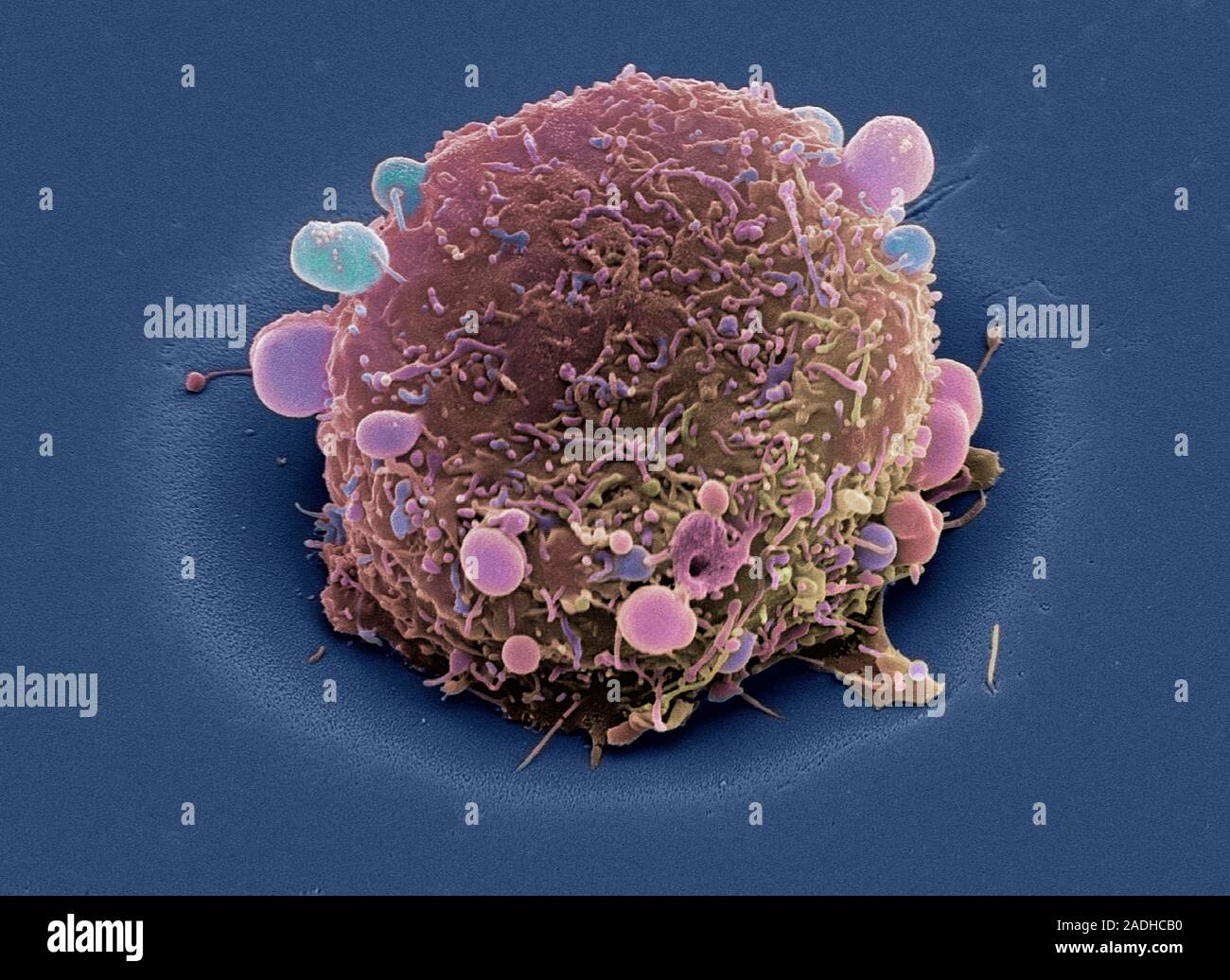 Lung cancer cell. Coloured scanning electron micrograph (SEM) of a lung ...