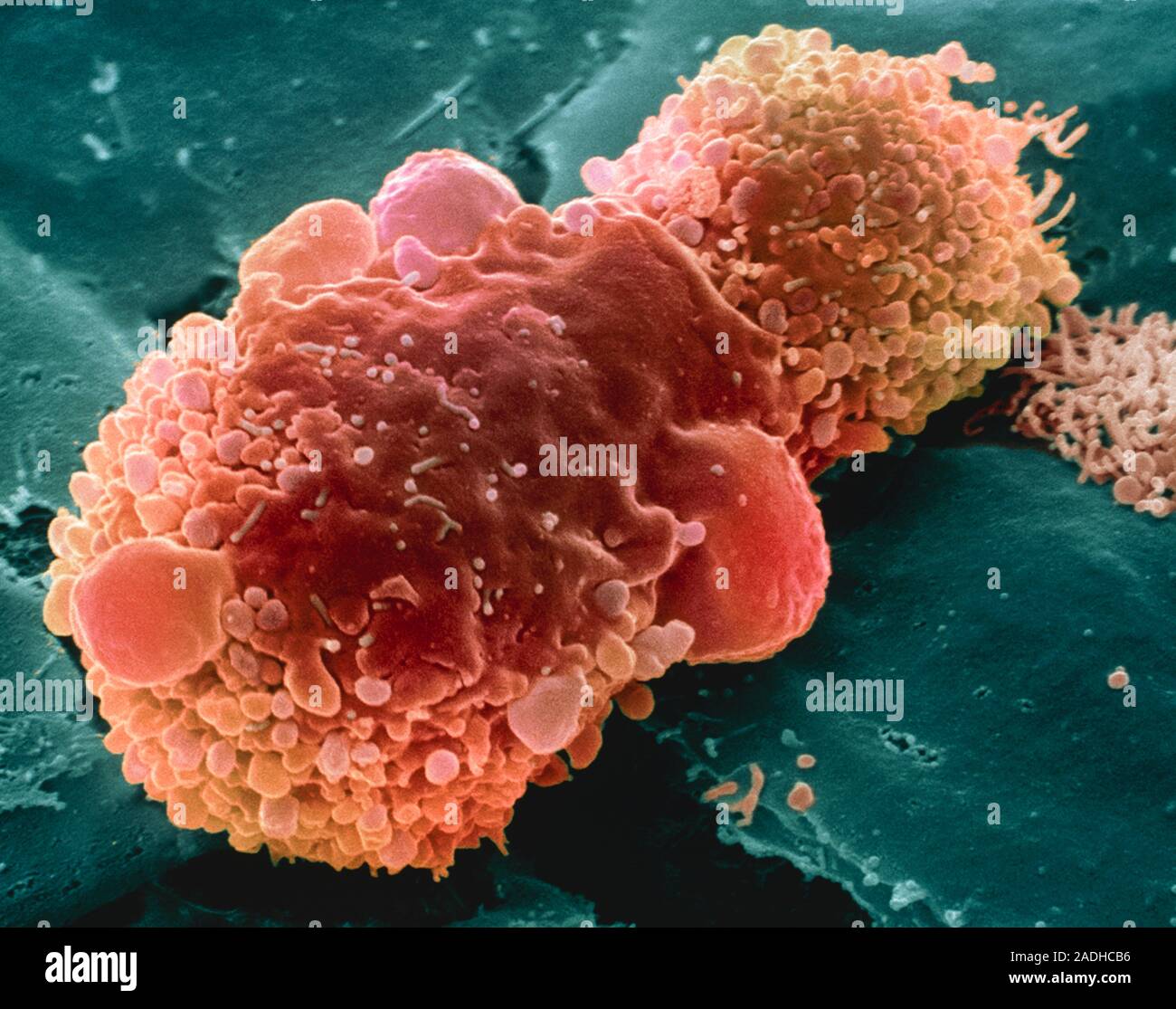 Lung cancer cell. Coloured scanning electron micrograph (SEM) of a lung ...