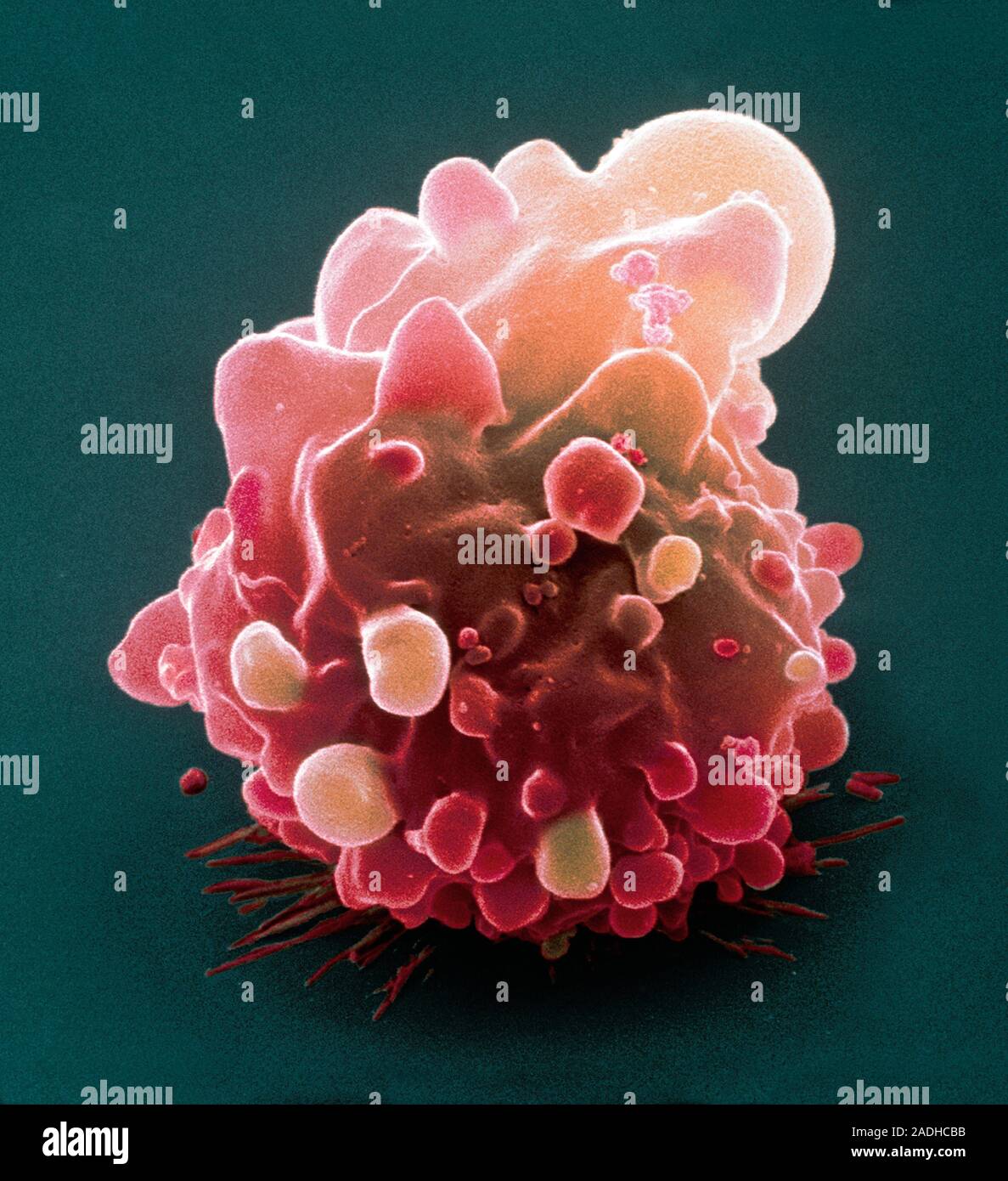 Bowel cancer cell. Coloured scanning electron micrograph (SEM) of an ...