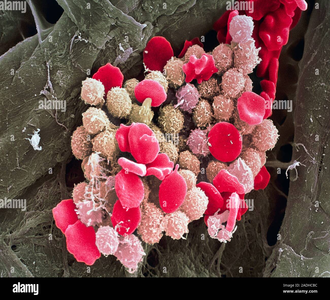 Leukaemia blood cells. Coloured scanning electron micrograph (SEM) of ...