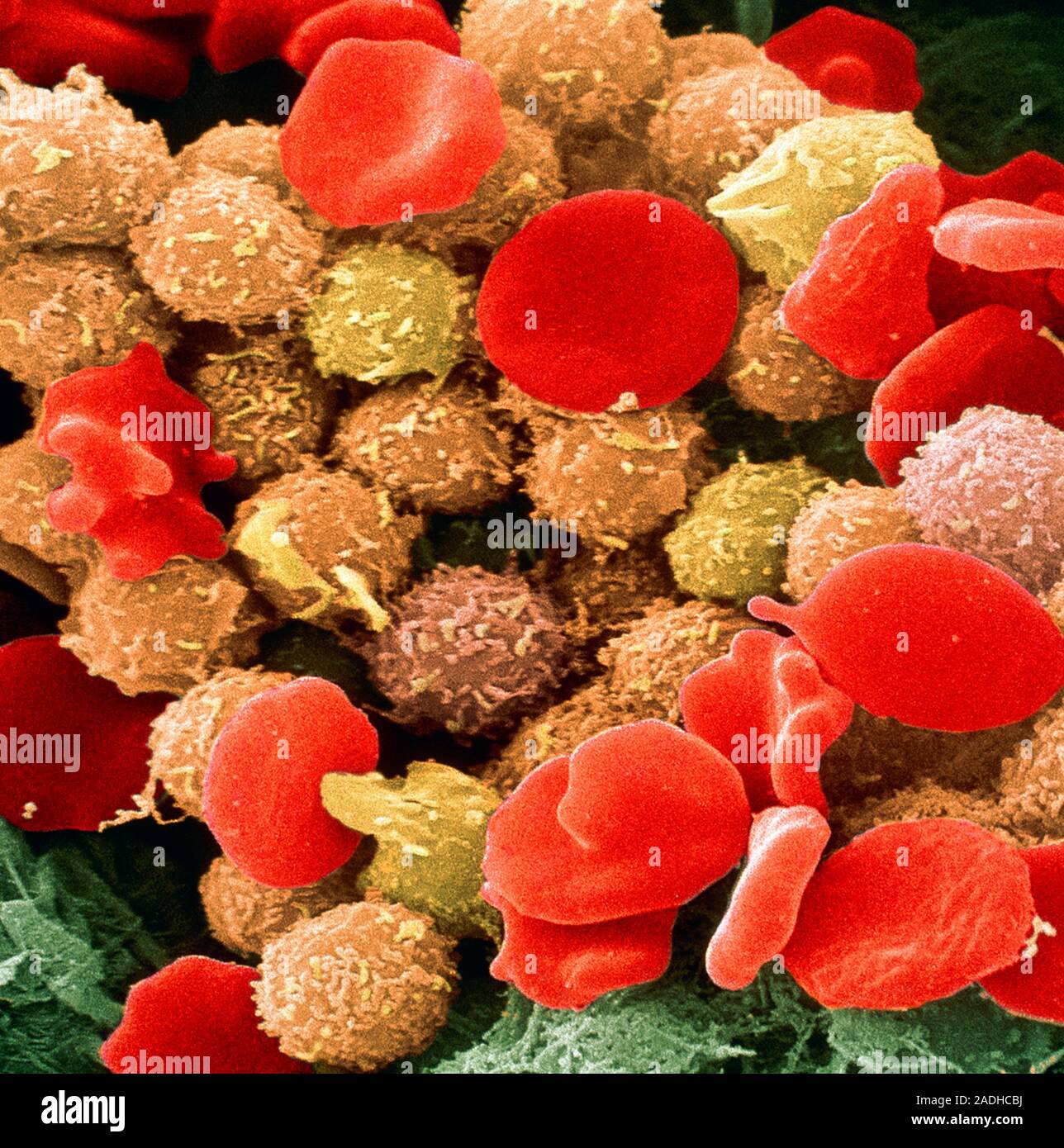 Leukaemia blood cells. Coloured scanning electron micrograph (SEM) of ...