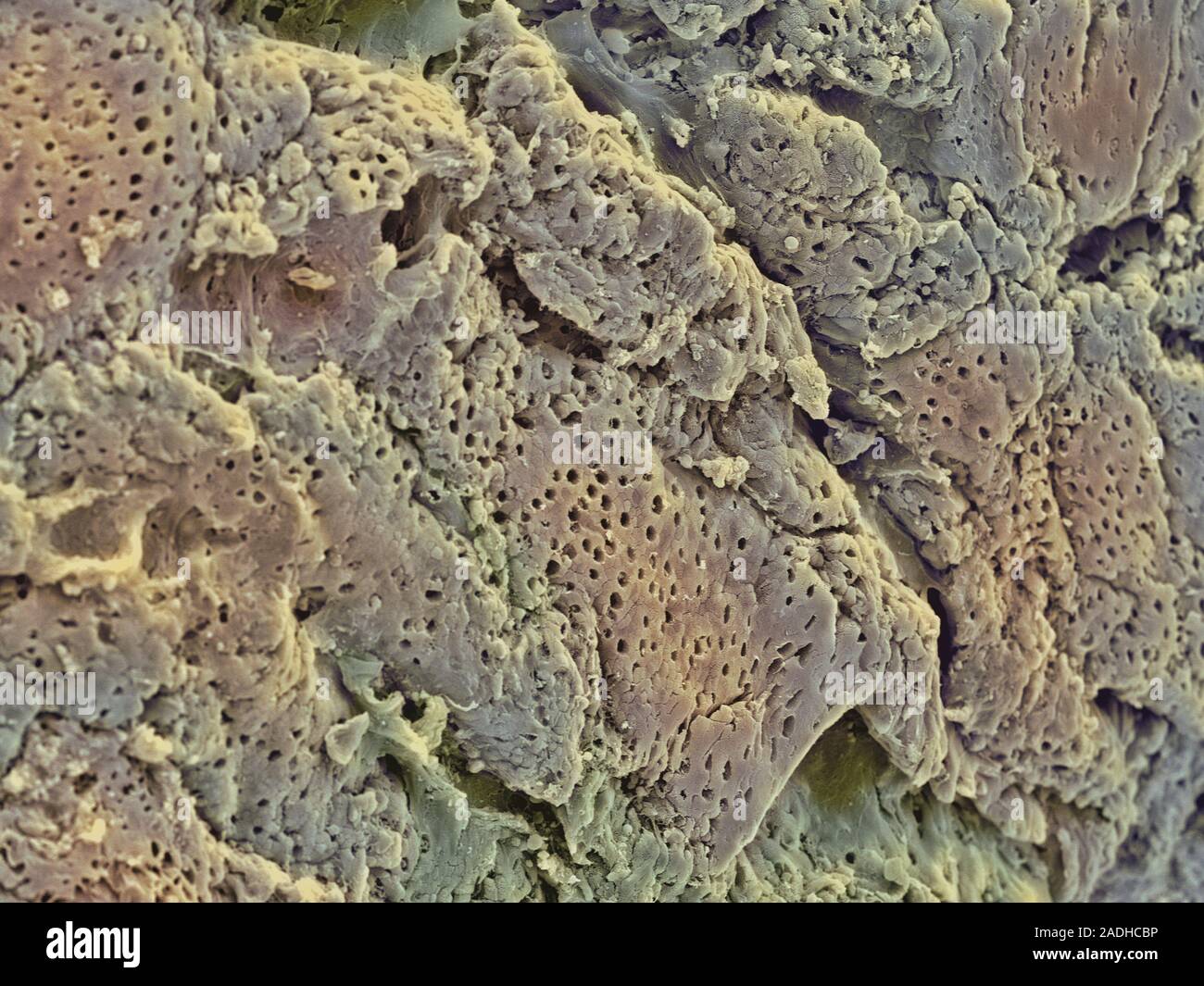 Colon Cancer Coloured Scanning Electron Micrograph Sem Of The Mucosal Surface Of A Cancerous