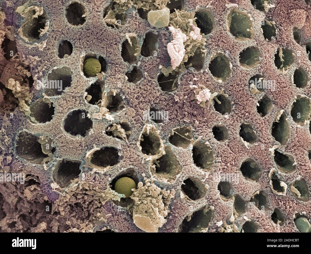 Colon cancer. Coloured scanning electron micrograph (SEM) of the ...