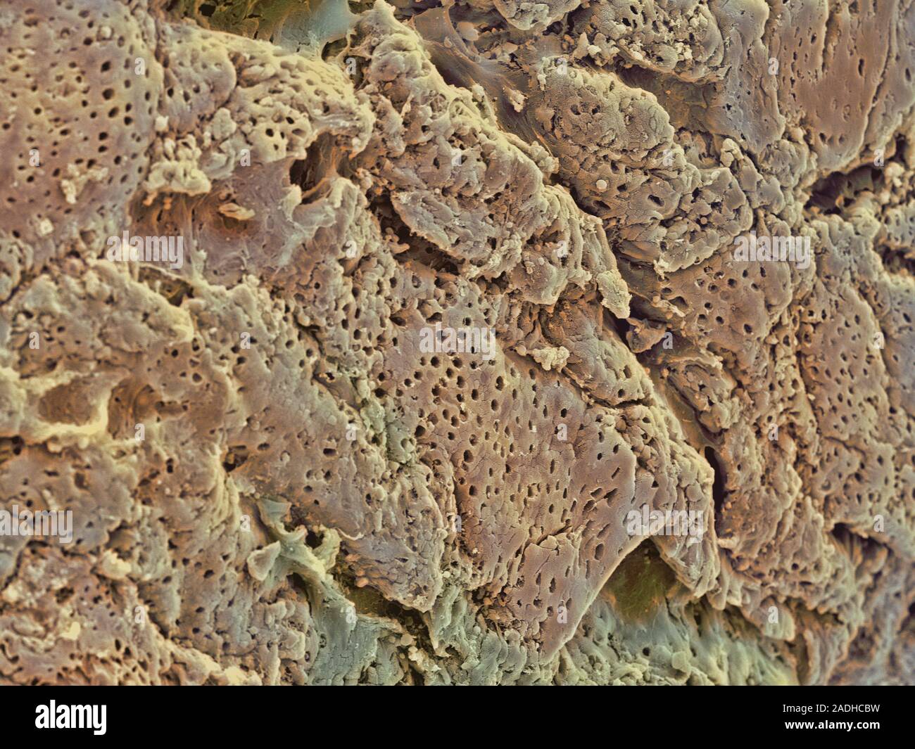 Colon cancer. Coloured scanning electron micrograph (SEM) of the ...