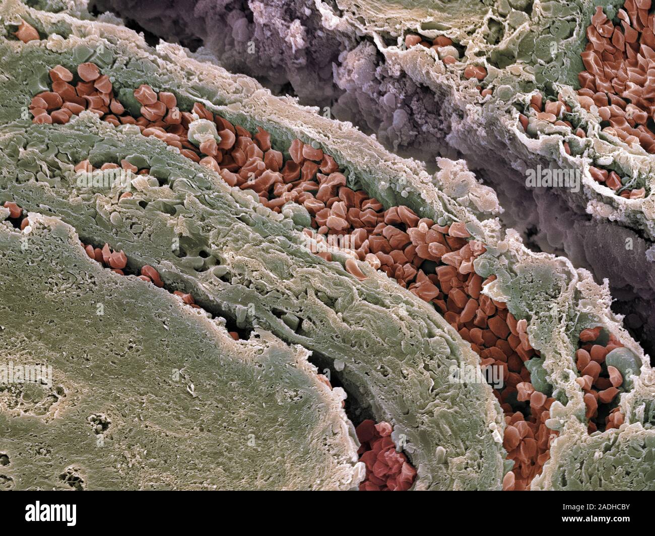 Colon cancer. Coloured scanning electron micrograph (SEM) of a freeze ...